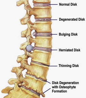 Slip disk disorders – Medical awareness https://ouruniquebody.com
